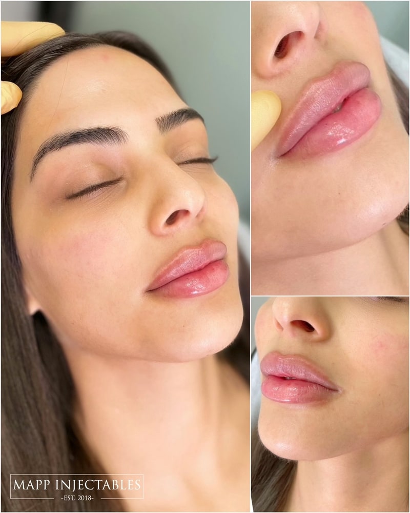 Difference Between 1ml Of Thin Med And Thick Lip Filler 